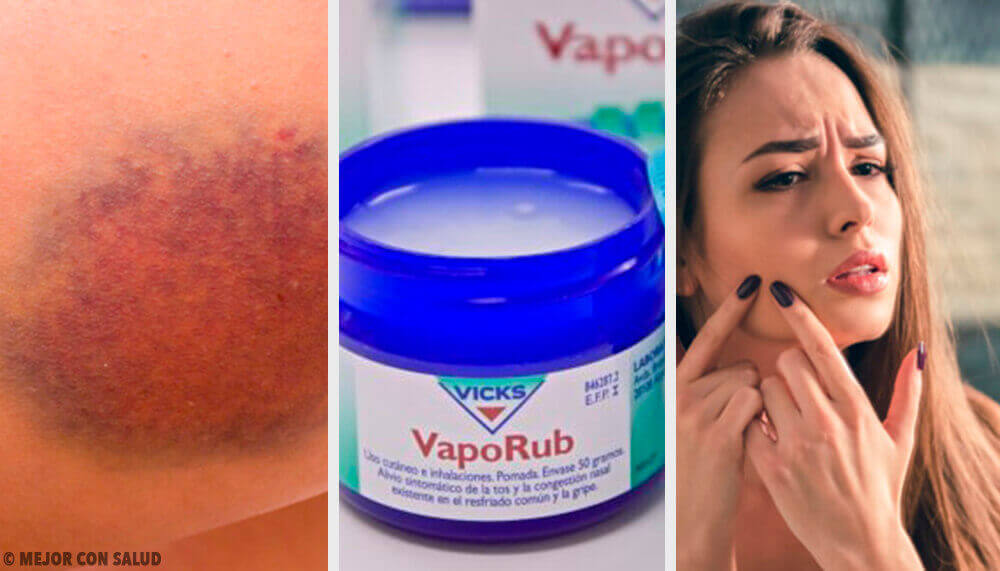 11 utilisations du fameux Vicks VapoRub - Améliore ta Santé