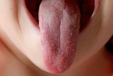 La scarlatine est-elle contagieuse ? - Améliore ta Santé