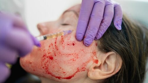 Soin du visage vampire : qu'est-ce que c'est et quels sont ses risques