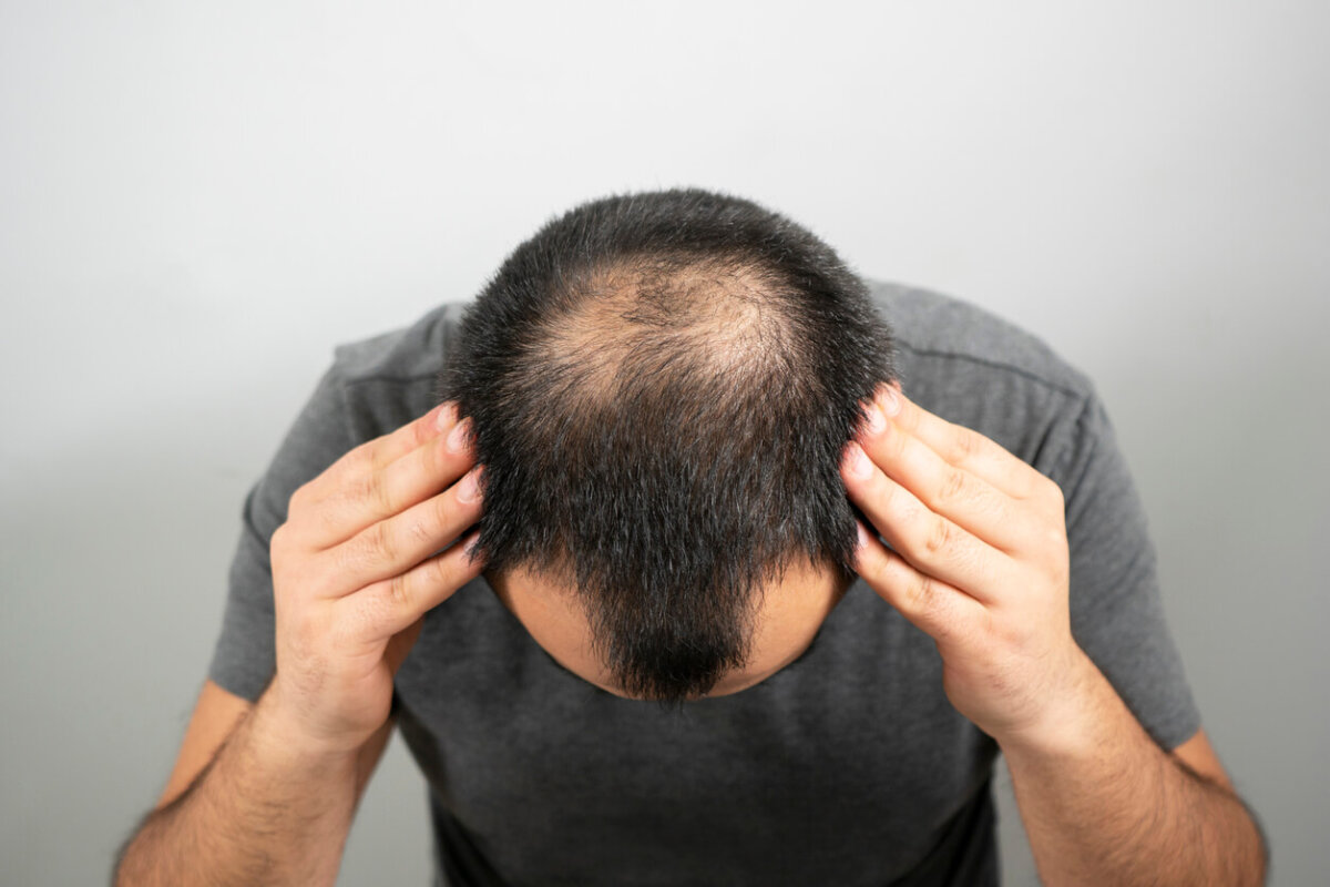 Lutte contre la calvitie : casques antichute et greffes de cheveux